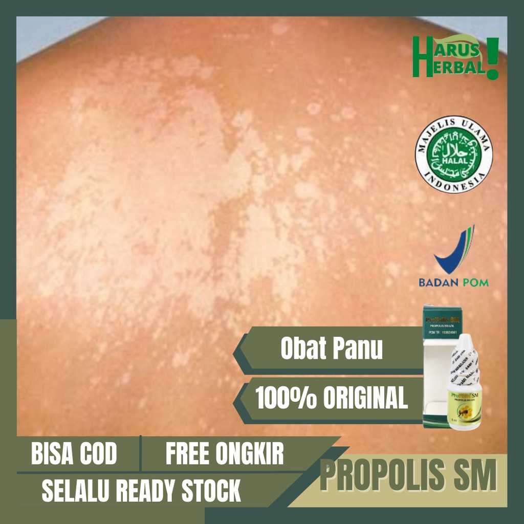 Jual Obat Penghilang Panu, Obat Panu Menahun, Obat Bercak Putih Di ...
