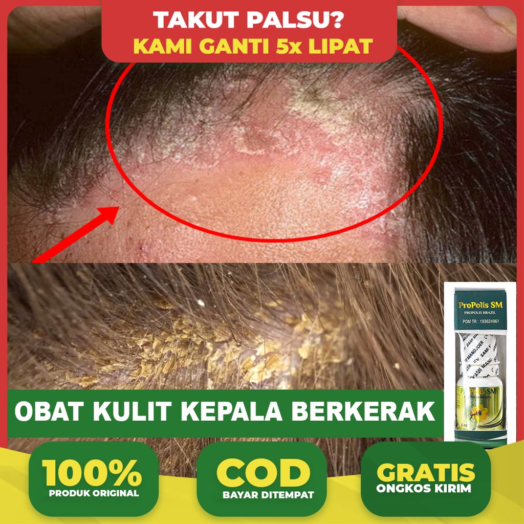 Jual Obat Kulit Kepala Berkerak - Kepala Kering Bersisik - Kepala Gatal Parah - Jamur di Kepala ...