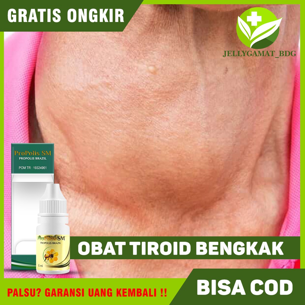 Jual Obat Tiroid Bengkak, Hipertiroid, Benjolan Lipoma Herbal Propolis ...