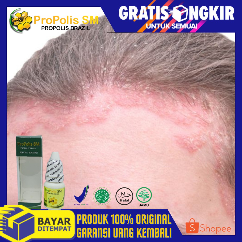 Jual Obat Kulit Kepala Mengelupas, Kulit Kepala Kering, Bersisik, Ketombe Berkerak - Propolis SM ...