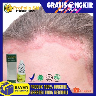Jual Obat Kulit Kepala Mengelupas, Kulit Kepala Kering, Bersisik, Ketombe Berkerak - Propolis SM ...