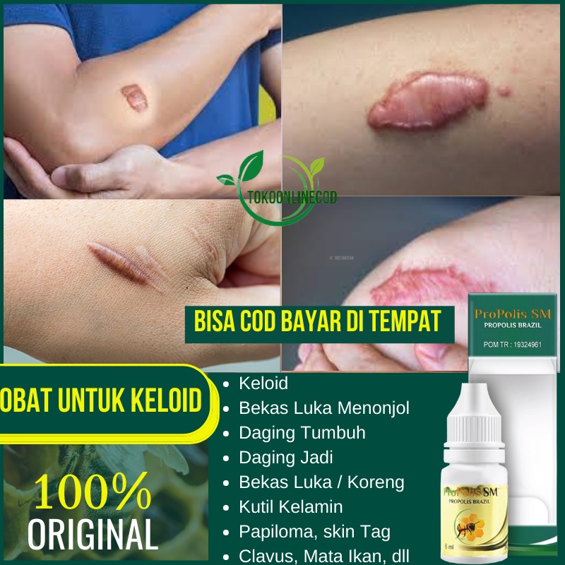 Jual Obat Keloid 100% Original, Penghilang Bekas Luka Pasca Operasi ...