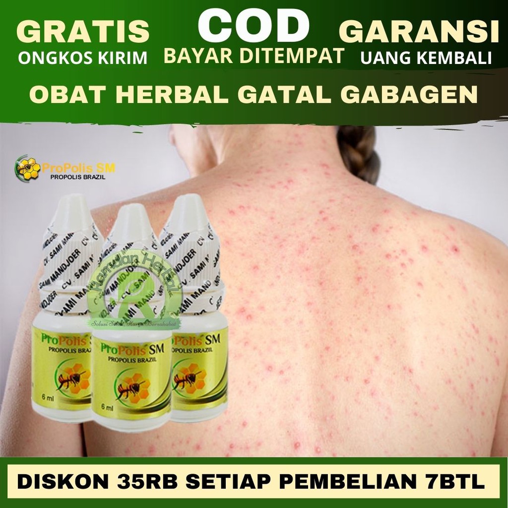 Jual Obat Gatal Gabagen Obat Gabagen Anak Dewasa Gatal Panas Propolis ...