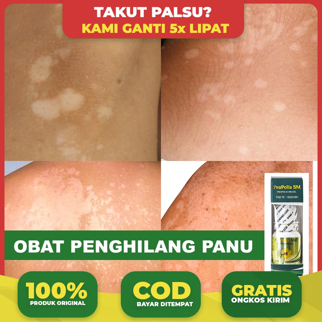 Jual Obat Penghilang Panu - Panu di Wajah,Badan,Tangan,Leher, jamur ...