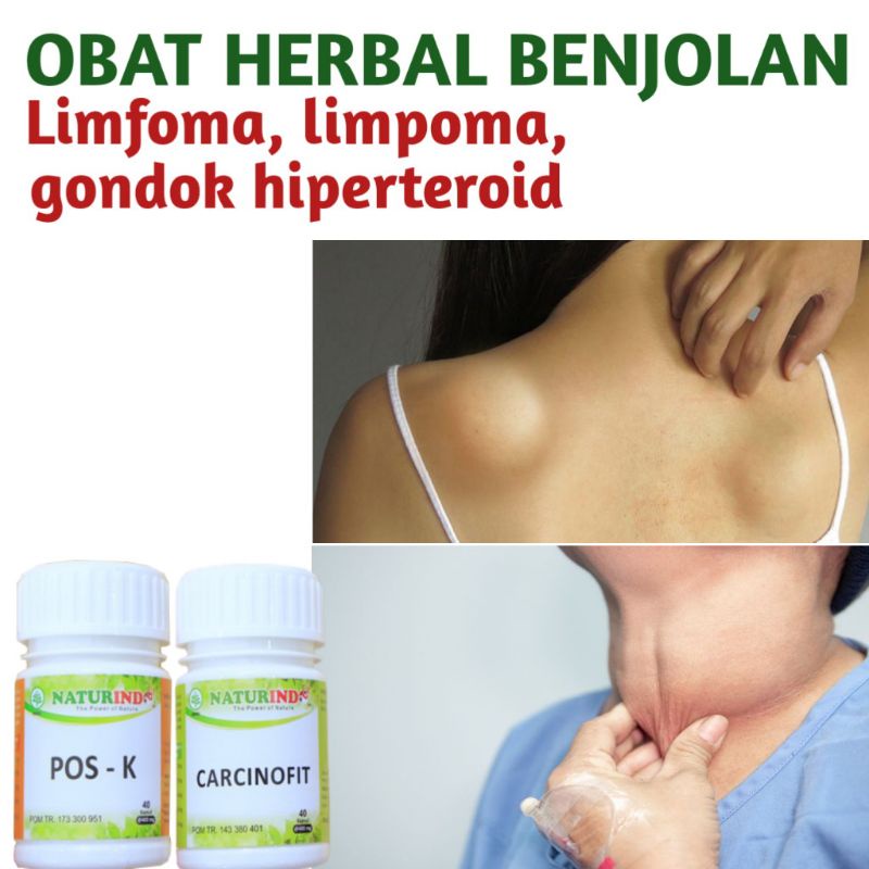 Jual Obat Gondok Hipertiroid Benjolan Dileher Kelenjar Tiroid Getah ...
