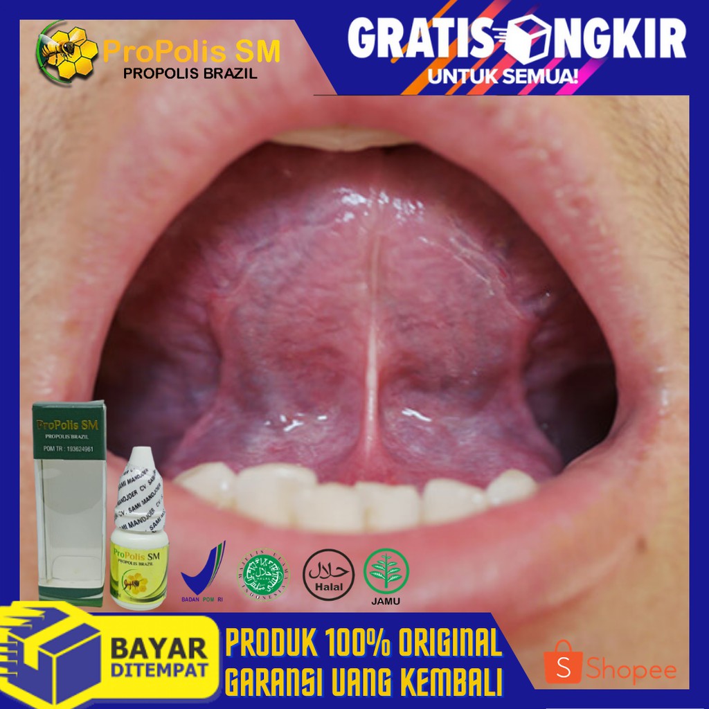 Jual Obat Benjolan Di Bawah Lidah, Benjolan Di Mulut, Benjolan Di ... Jual Obat Benjolan Di Bawah Lidah, Benjolan Di Mulut, Benjolan Di ...