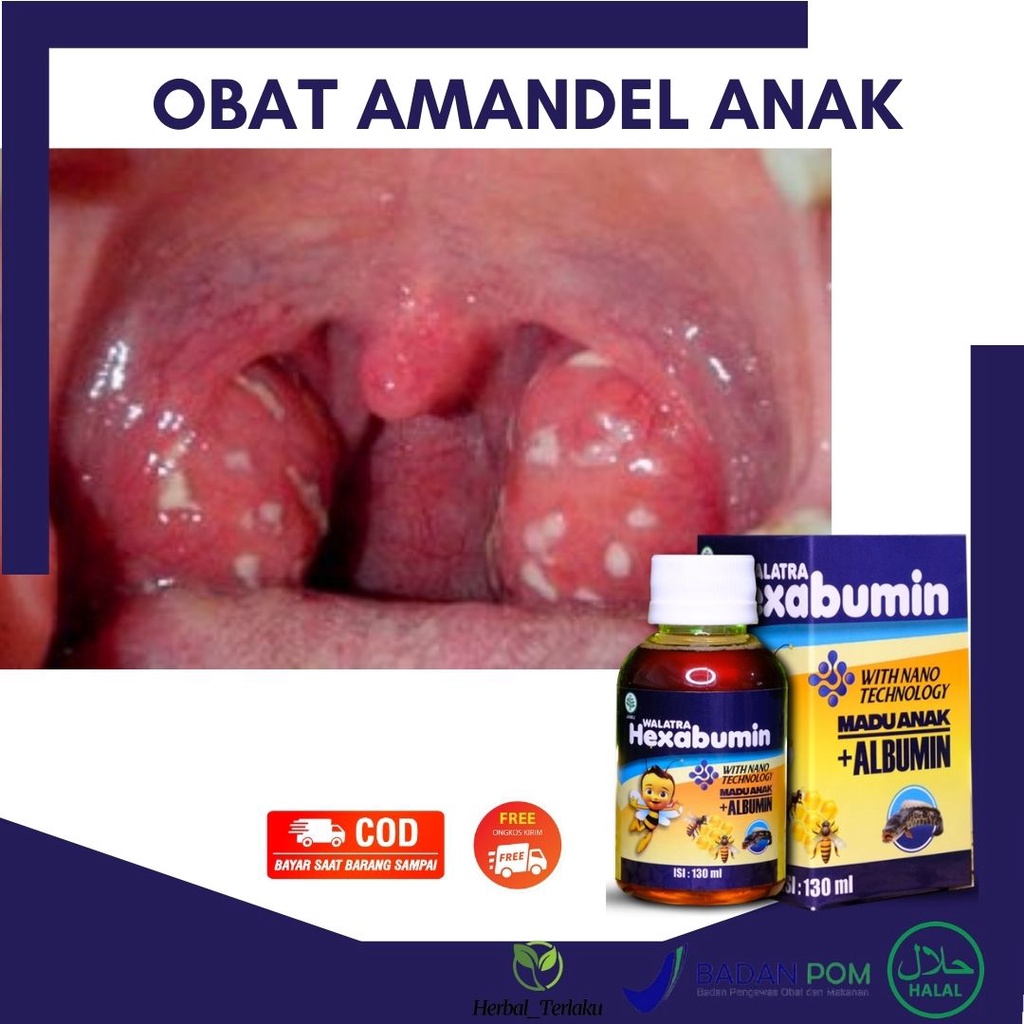 Jual Obat Amandel Khusus Anak , Ujung Tenggorokan Benjol , Amandel ...