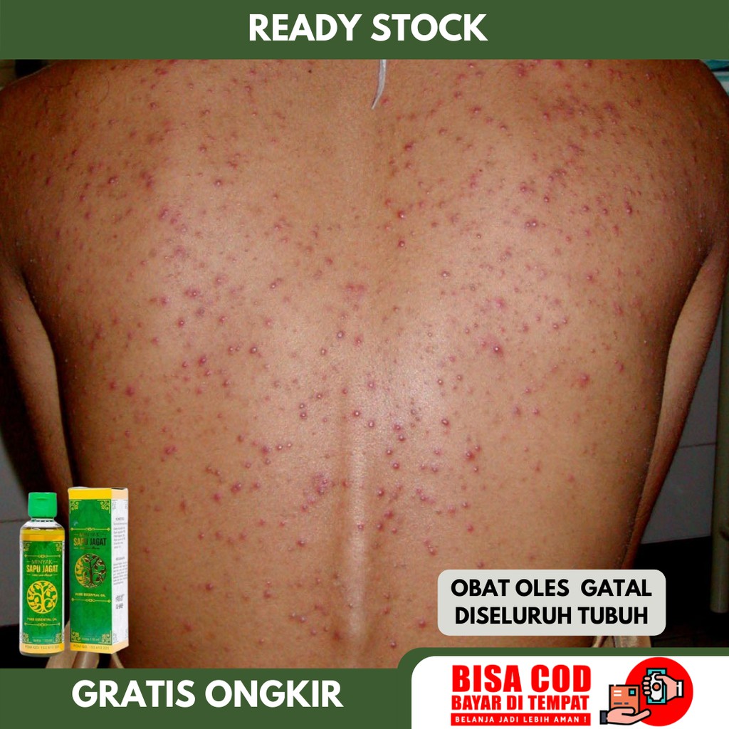 Jual Obat Gatal-Gatal Di Seluruh Badan, Obat Alergi, Obat Gangguan ... Jual Obat Gatal-Gatal Di Seluruh Badan, Obat Alergi, Obat Gangguan ...