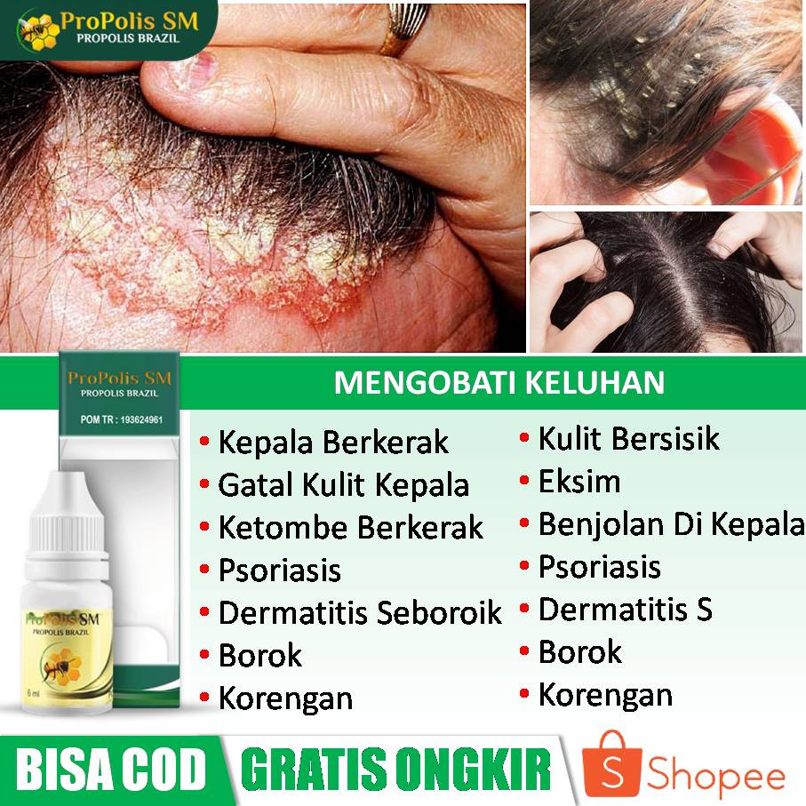 Jual Obat Oles Gatal Kulit, Gatal Kulit Kepala, Psoriasis, Ketombe Berkerak, Borok Di Kepala ...