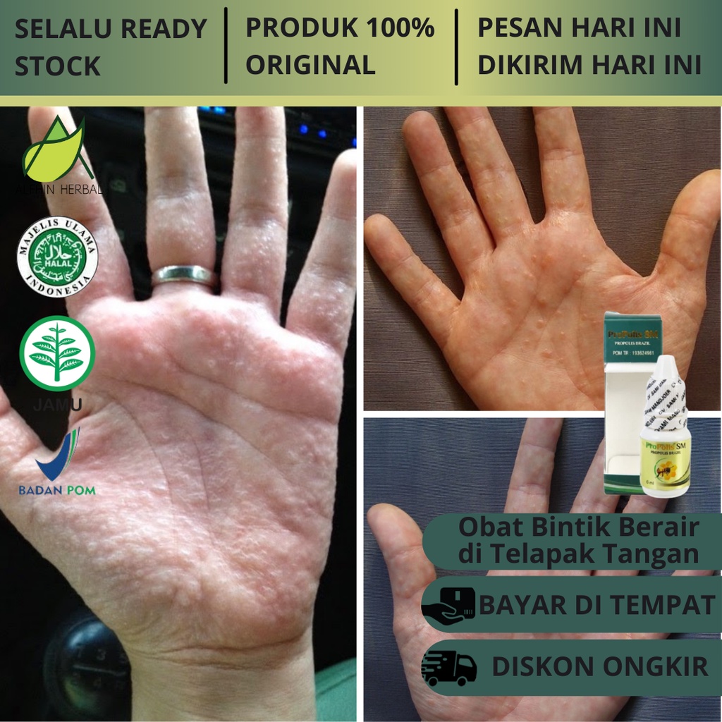 Jual Obat Bintik Berair Di Telapak Tangan, Obat Penghilang Gatal ...