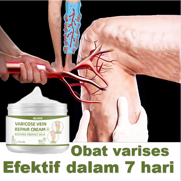 Jual Obat varises Varises Cream Salep Penghilang Bekas Penghilang ...