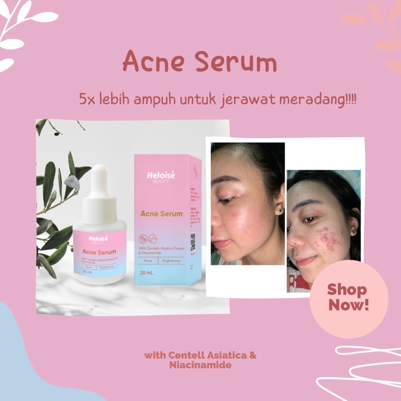 Jual Acne & Brightening Serum Centella Asiatica by Heloise Beauty 20ml ...