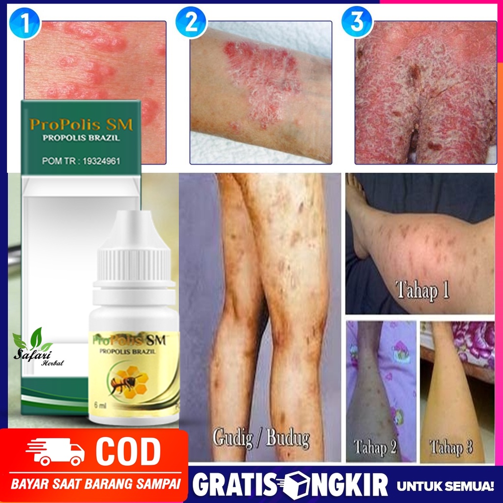 Jual Obat Skabies / Gudik / Budug, Obat Korengan / Penghilang Bekas ...