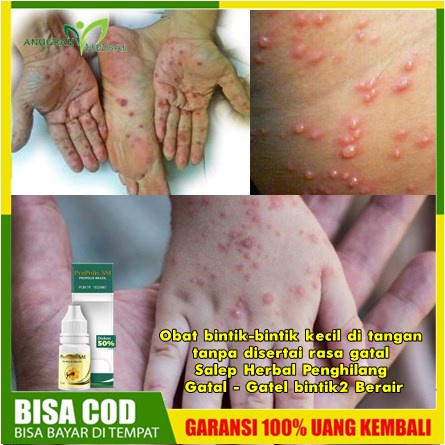 Jual Obat bintik-bintik kecil di tangan tanpa disertai rasa gatal ...