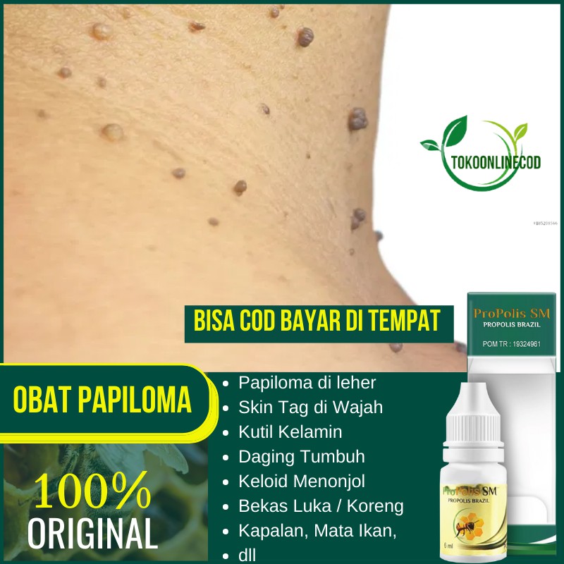 Jual Obat Papiloma Tradisional, Penghilang Skin Tag di Leher, Daging ...