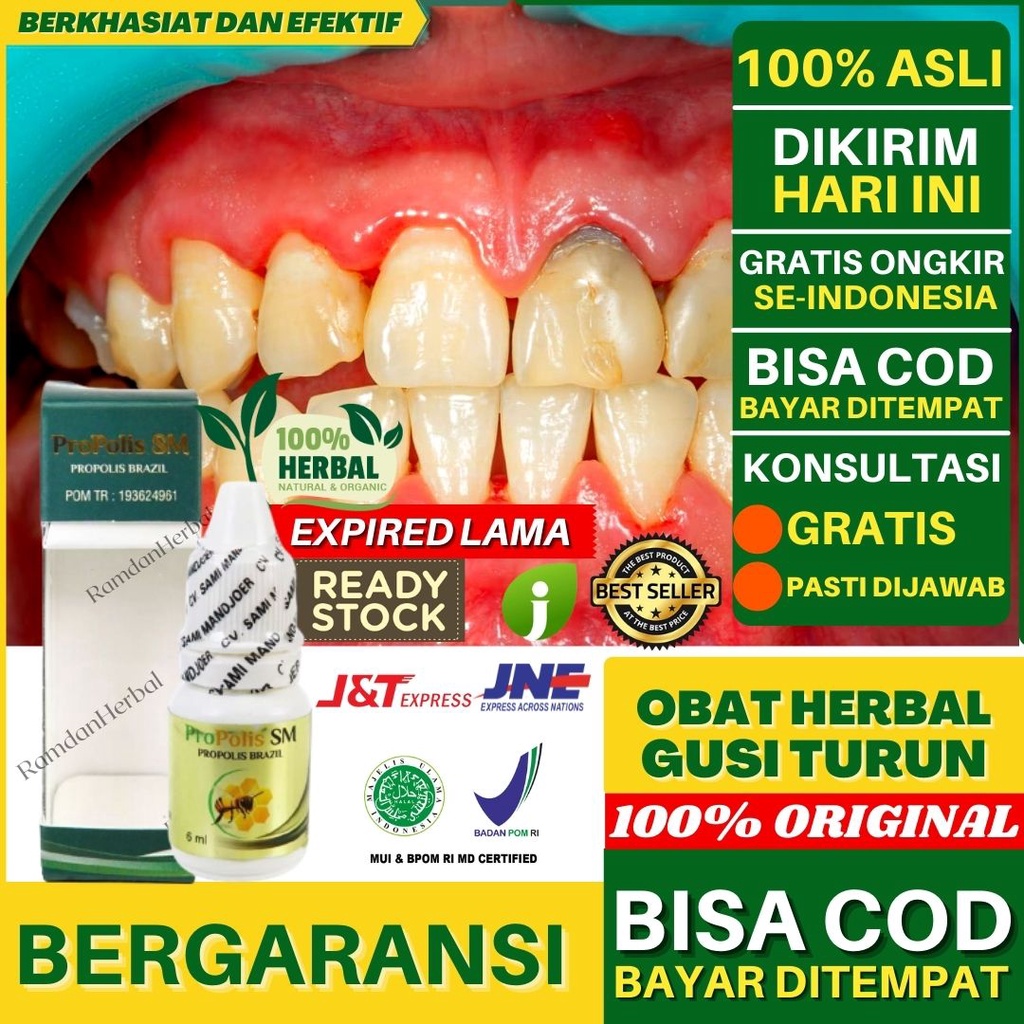 Jual Obat Gusi Turun Propolis SM Obat Resesi Gingiva Penyakit Gusi ...
