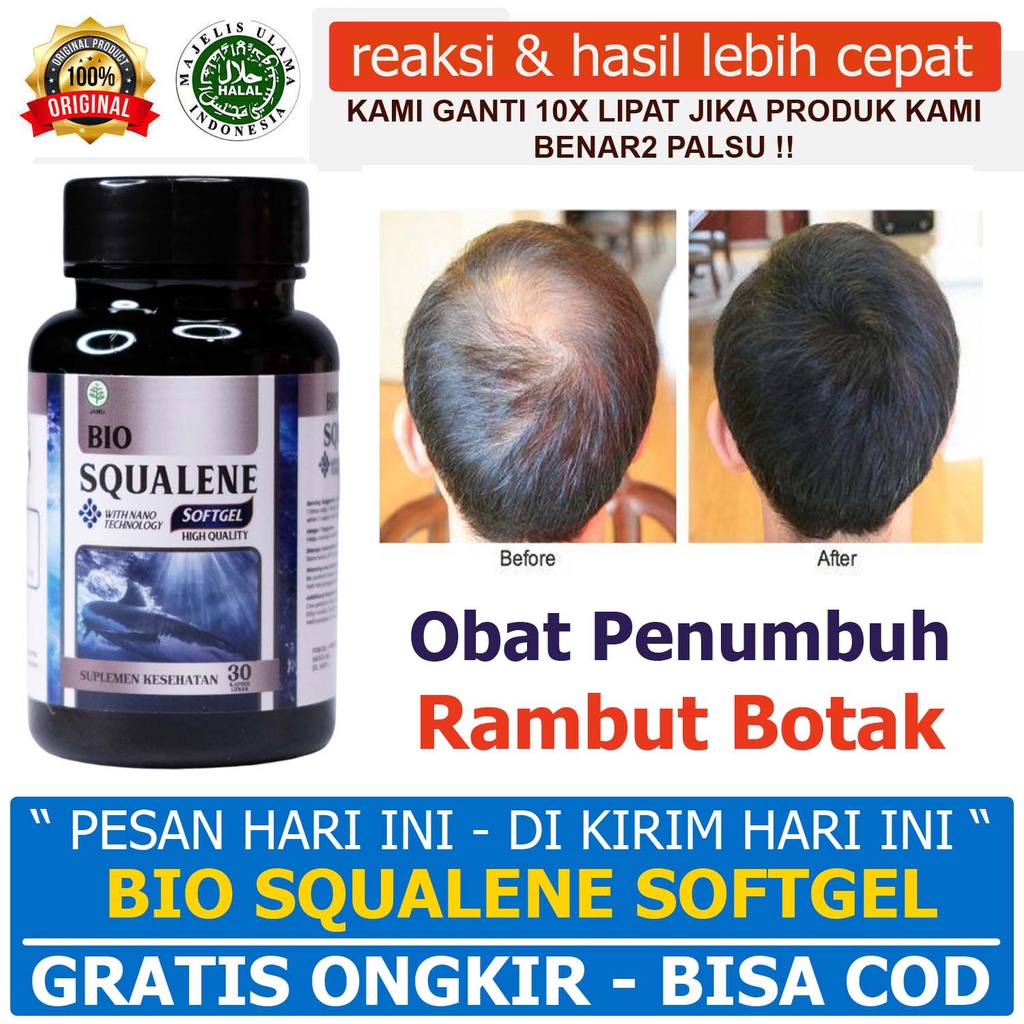 Jual Obat Penumbuh Rambut Botak, Tipis dan Rontok, Alopecia Areata ...
