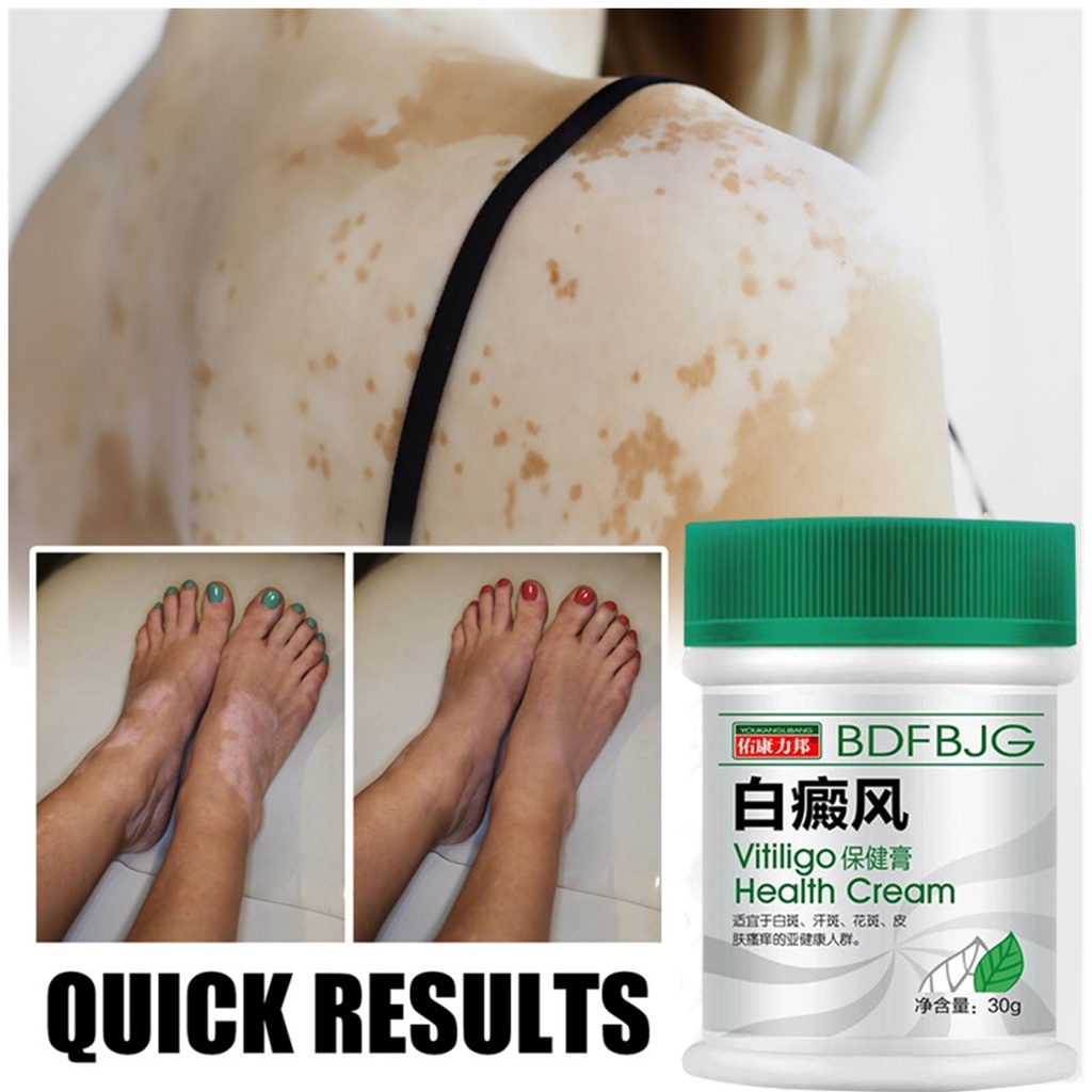 Jual Vitiligo White Spot Repigmentation Kulit/Ampuh Obat Cream ...