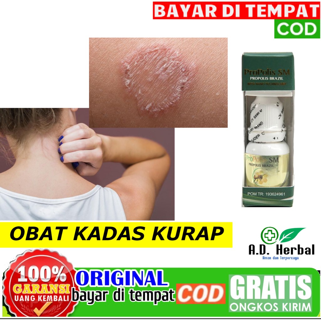 Jual Obat Kadas Kurap Gatal kulit di leher, paha, tangan, kaki punggung ...