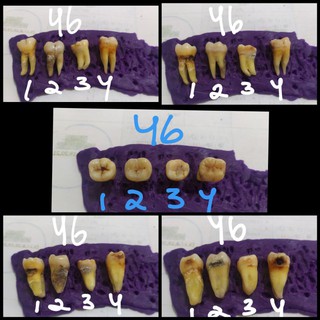 Jual Gigi Asli FKG gigi sulung/ gigi insisive gigi insisif/ gigi ...