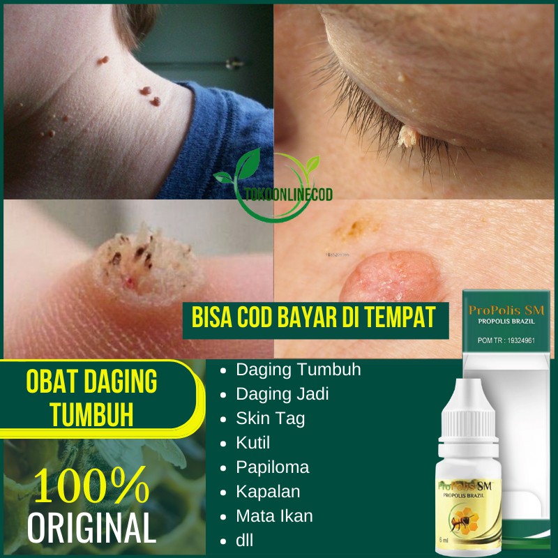 Jual Obat Penghilang Daging Tumbuh Skin Tag Kutil Kapalan Cacar Monyet ...