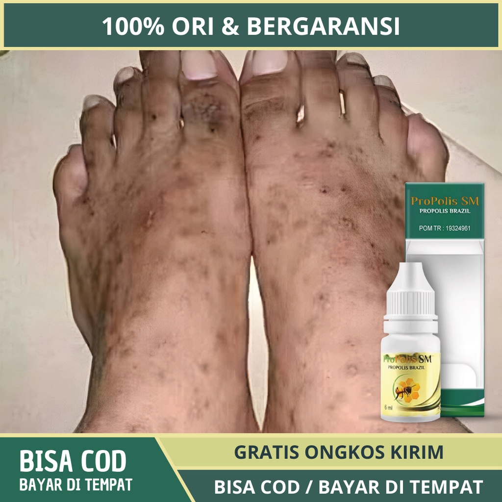 Jual Obat Koreng di Kaki, Obat Penghilang Koreng di Kaki, Obat ...