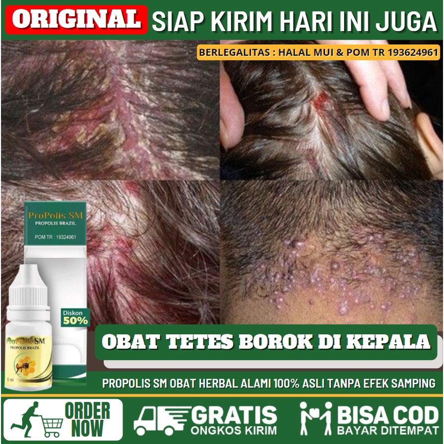 Jual Obat Cair / Salep Kulit Kepala Borok 100% Asli Alami, Obat Kulit Kepala Gatal Gatel ...