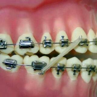 Jual Karet Elastics Elastis Behel Ortho Rubber Band | Shopee Indonesia