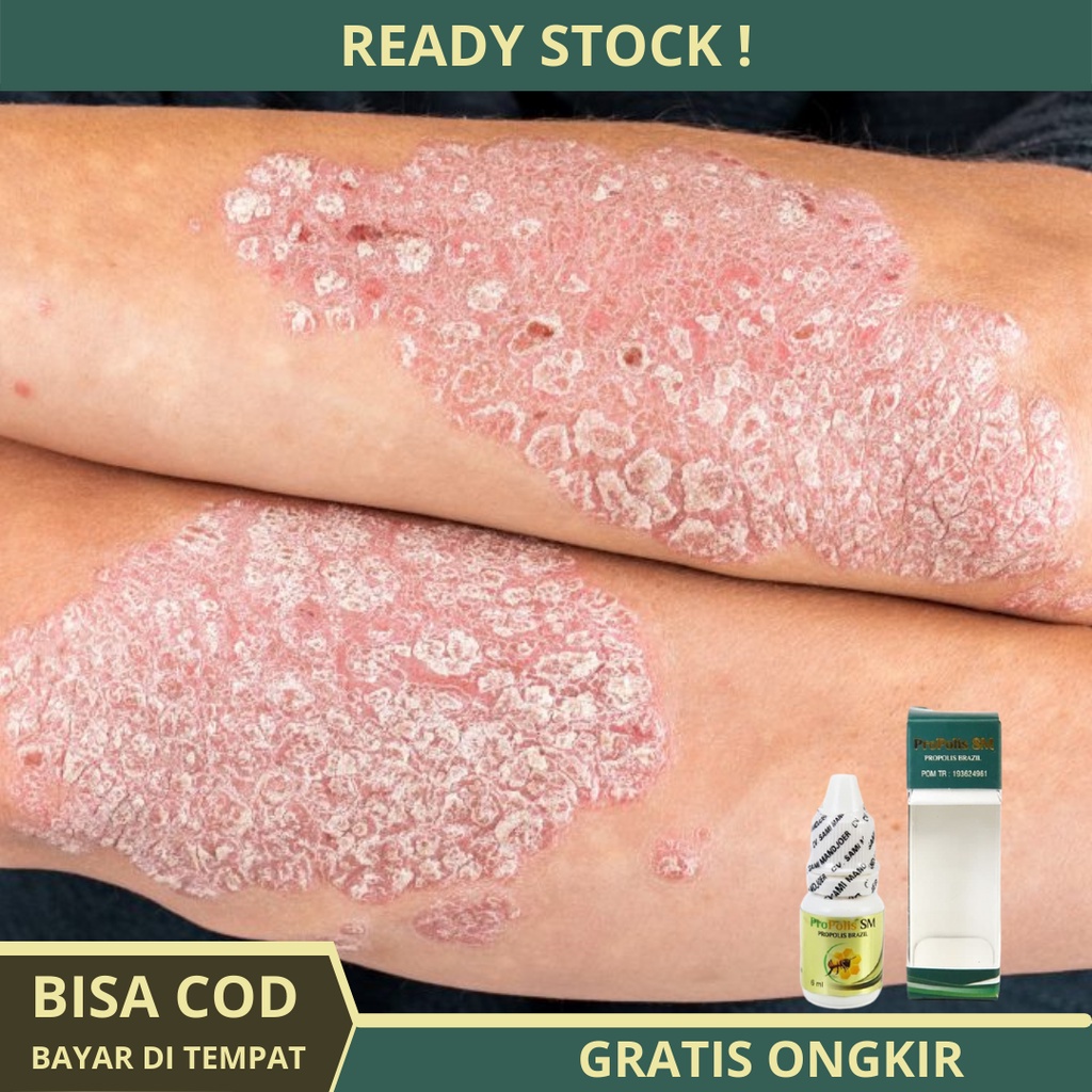 Jual Solusi Obat Penyakit Kulit Psoriasis Kering Dan Kasar di Lutut ... Jual Solusi Obat Penyakit Kulit Psoriasis Kering Dan Kasar di Lutut ...