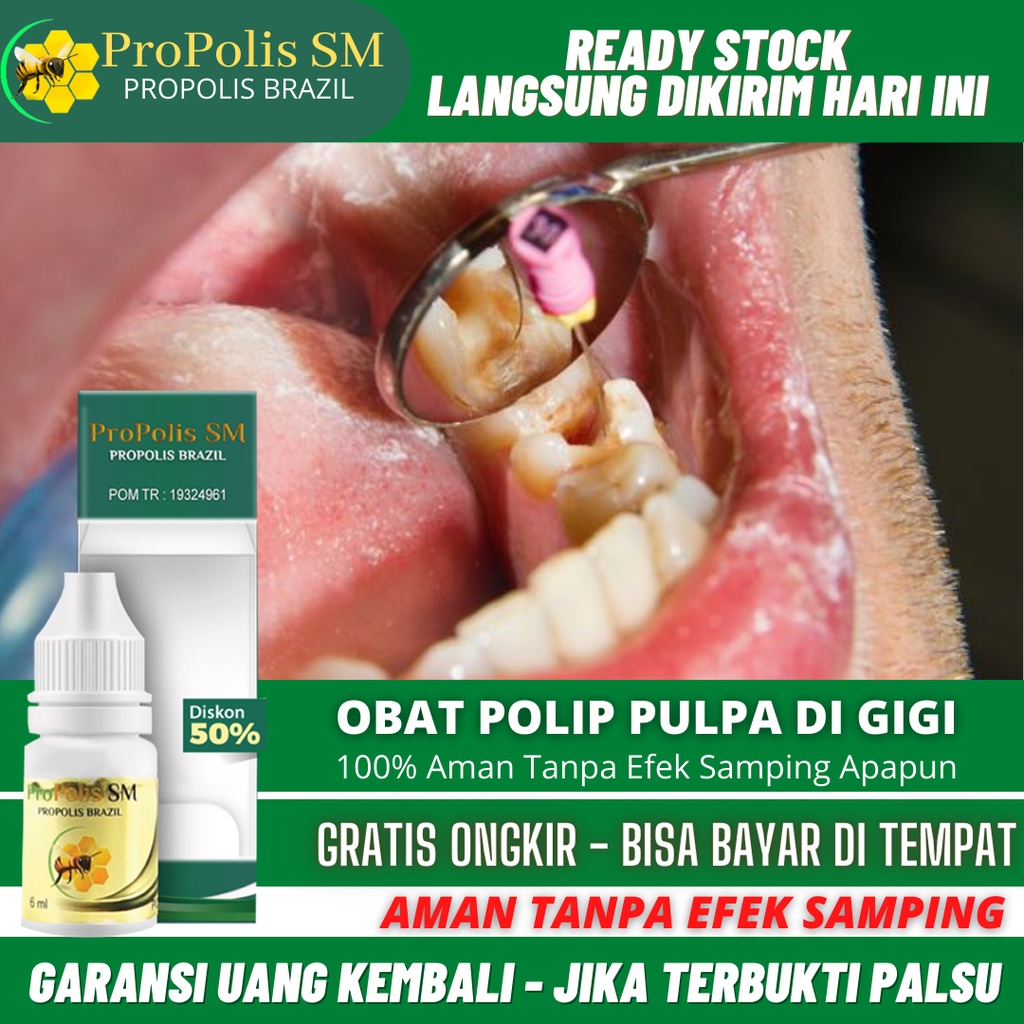 Jual Obat Penghilang Daging Jadi Di Gusi, Obat Pengempis Polip Gigi ...
