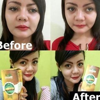 Jual ASLI Obat Mata Juling - Mata Tidak Sejajar - Strabismus - Mata ...