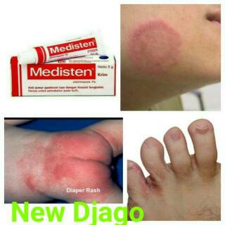 Jual MEDISTEN CREAM KRIM PANU JAMUR KADAS KUTU AIR RUAM POPOK | Shopee ...