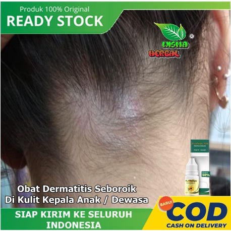 Jual Obat Dermatitis Seboroik Di Kulit Kepala Anak / Dewasa | Menghilangkan Gatel2 Kulit ...