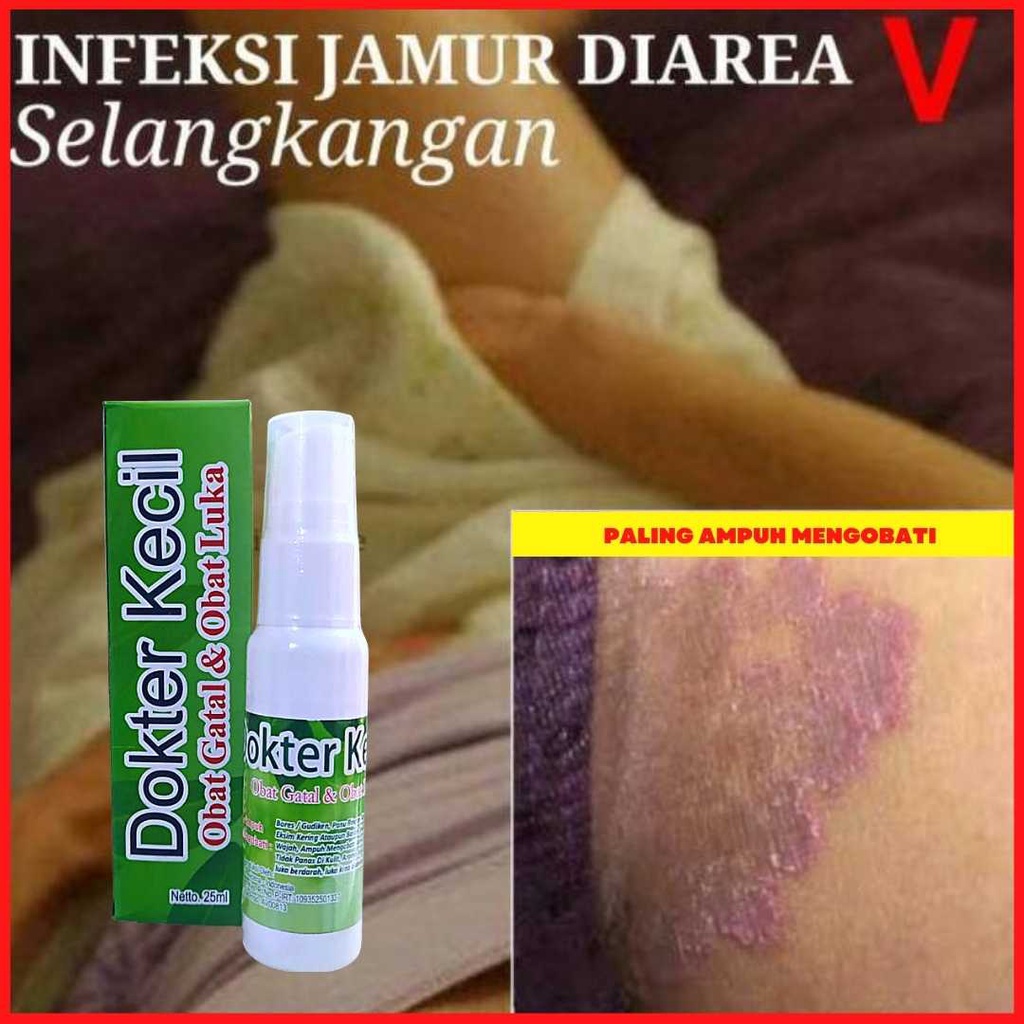 Jual Obat Gatal Kulit Selangkangan Eksim Kering Menahun Koreng Bernanah ...
