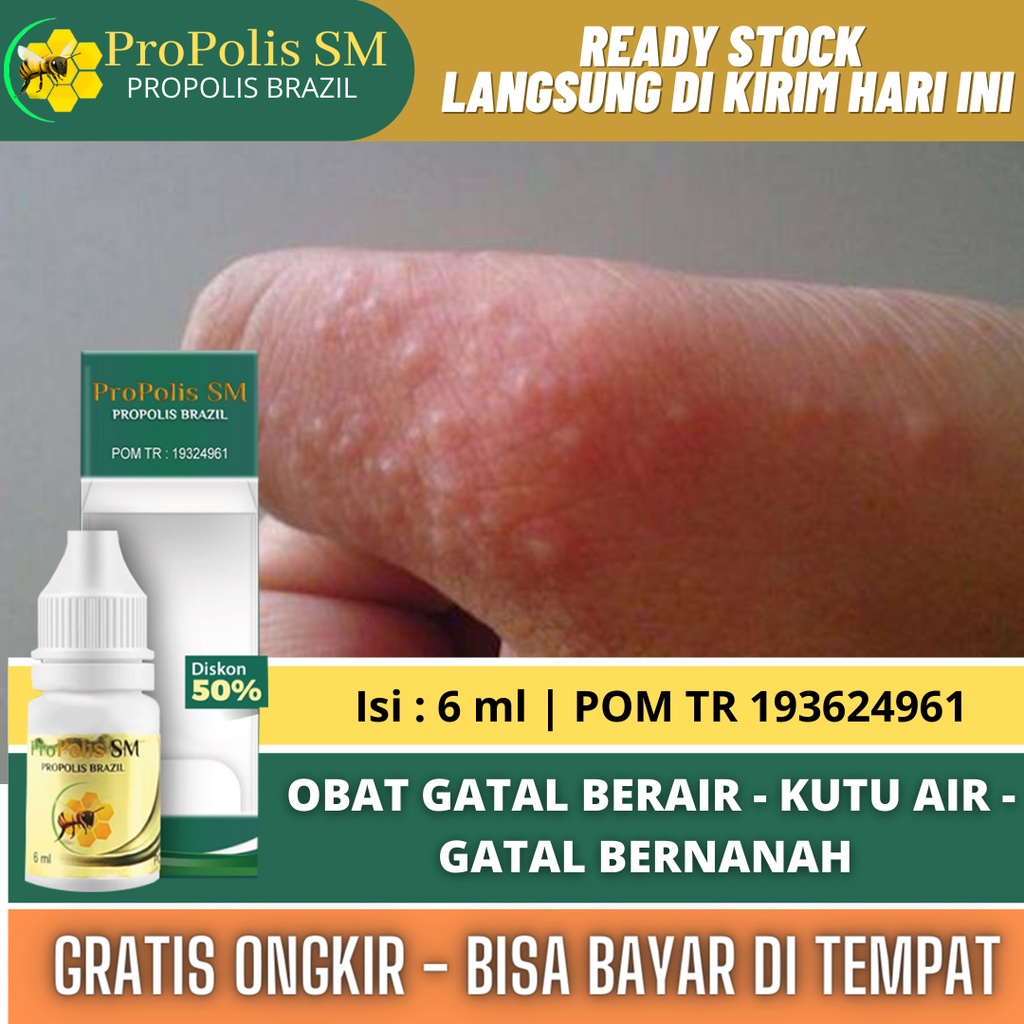 Jual Obat Gatal Berair di Jari Tangan dan Kaki, Gatal Berair Dan ...
