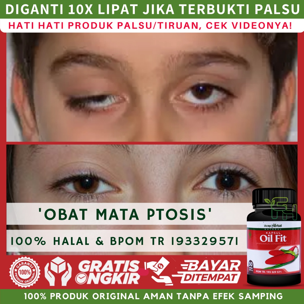 Jual Obat Alami Mata Ptosis Obat Kelopak Mata Turun Sebelah Mata Beda ...