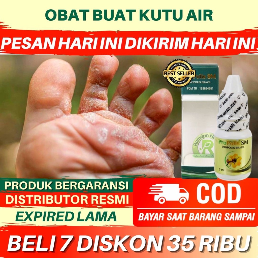 Jual Obat Buat Kutu Air / Penghilang Kutu Air / Gatal Kaki / Sela Sela ...
