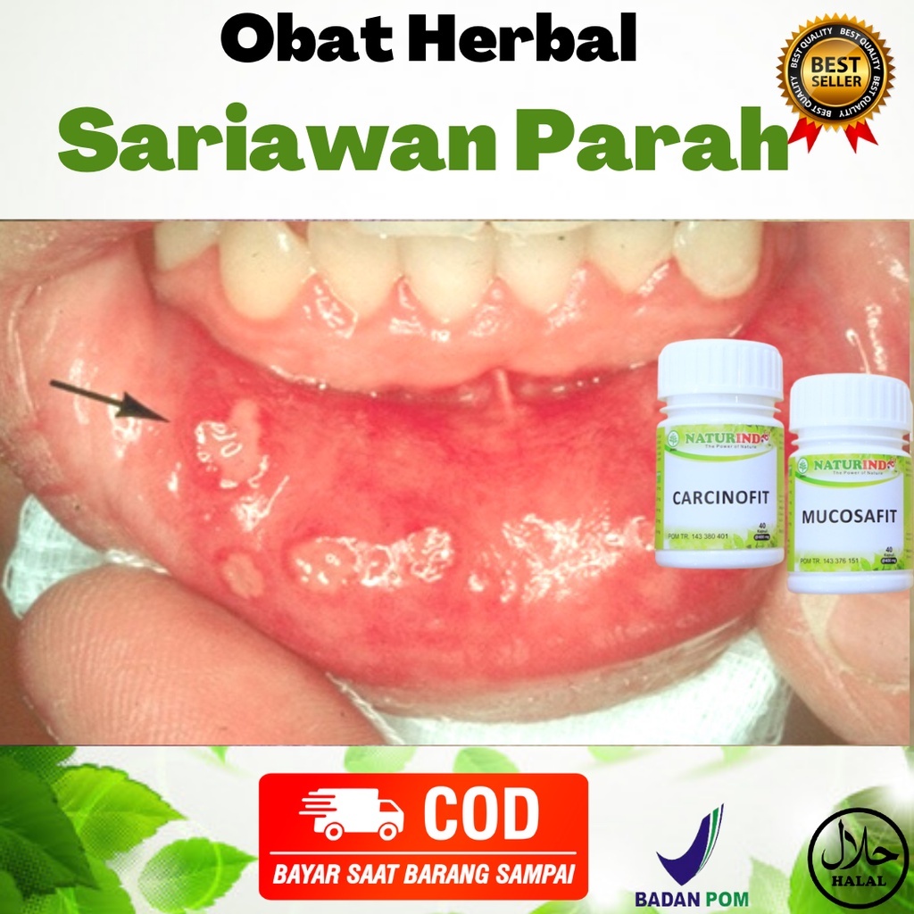Jual Obat Sariawan Mulut Lidah Radang Kronis Akut Karena Asam Lambung ...