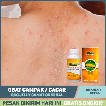 Jual Obat Campak Anak dan Dewasa Cacar Api, Cacar Ayam, Cacar Monyet ...