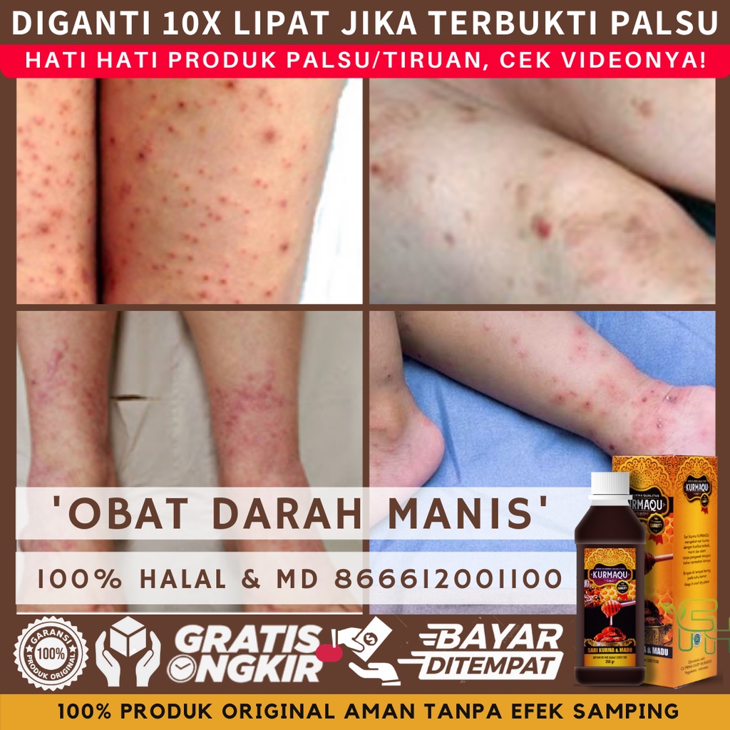 Jual Obat Darah Manis Di Kaki, Prurigo, Gatal Darah Manis, Gatal Kulit ...