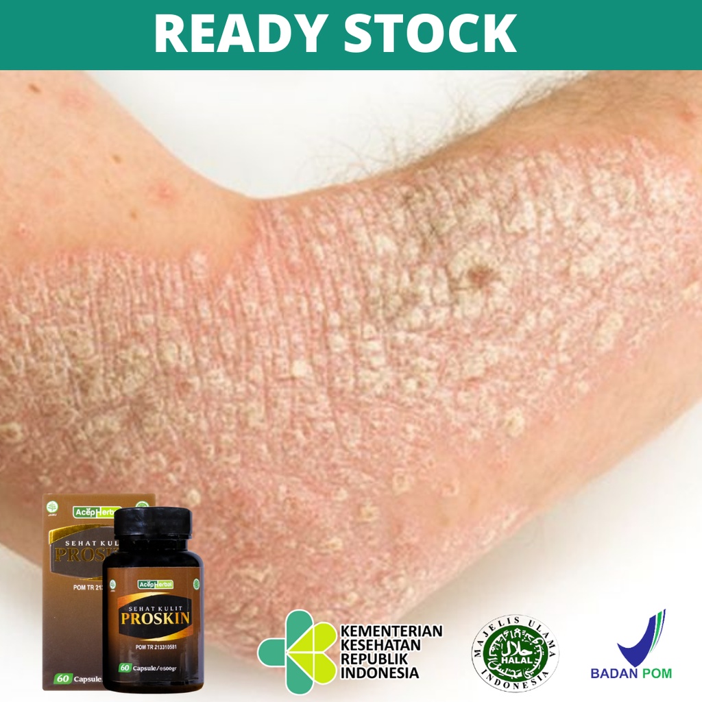 Jual Obat Gatal Eksim Kering, Eksim Basah, Obat Kulit Gatal Memerah dan ...