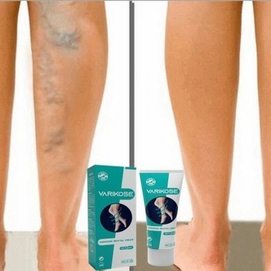 Jual VARIKOSE 100% ASLI VARIKOSE ORIGINAL CREAM ATASI VARISES - STRECK ...