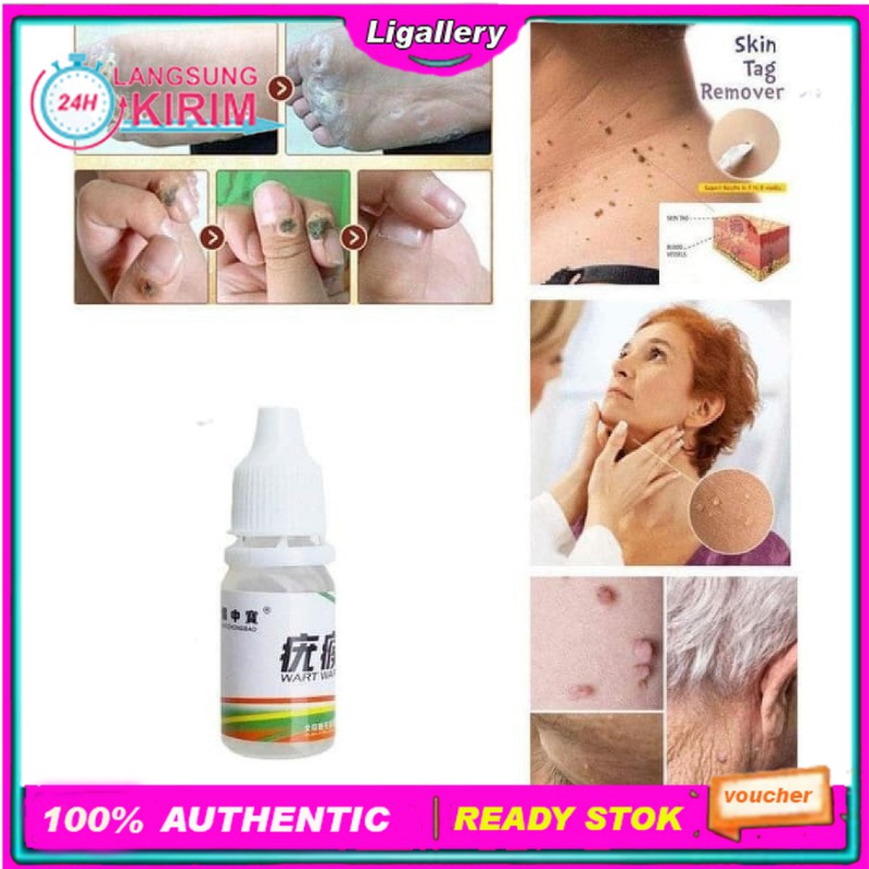 Jual Ligallery - skin tag remover menghilangkan kutil tahi lalat mata ...