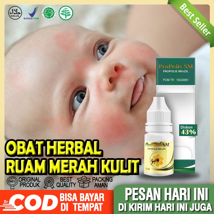 Jual Obat Ruam Merah, Obat Gatal Ruam Merah, Obat Ruam Merah Anak, Obat ...