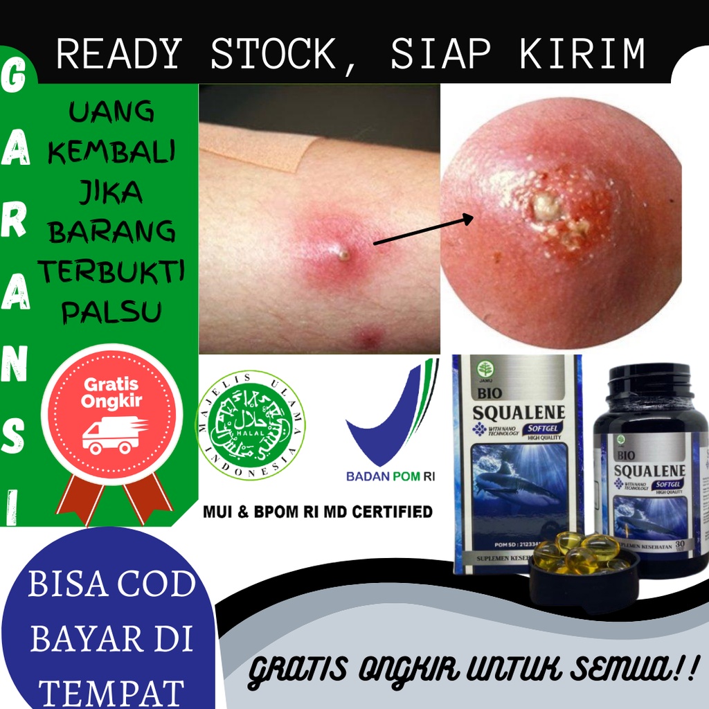 Jual Obat Penghilang Bisul, Lipoma, Benjolan Tiroid, Gondok / Gondongan - BIO SQUALENE 100% ...