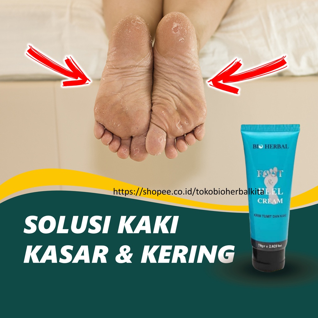 Jual Salep Kaki Pecah Dan Kering Ampuh Obat Telapak Kaki Pecah Obat Rorombeheun Kaki Foot Cream ...