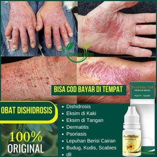 Jual Obat Dishidrosis - Eksim di Kaki dan Tangan - Dermatitis ...