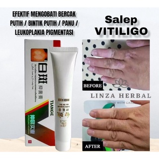 Jual OBAT SALEP VITILIGO BERCAK PUTIH / KULIT BELANG Putih panu belang ...