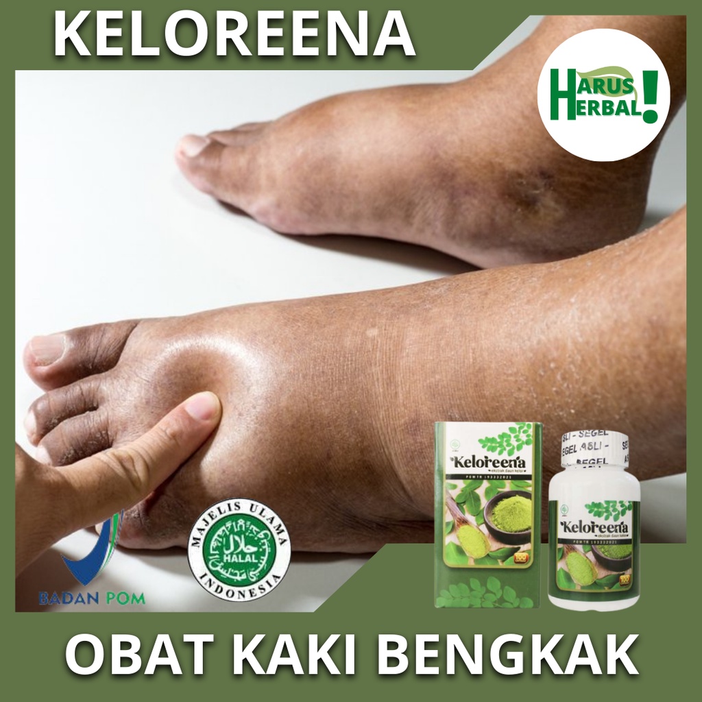 Jual Obat Kaki Bengkak Diabetes, Obat Kaki Edema, Obat Kaki Bengkak ...
