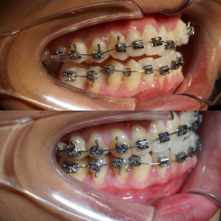 Jual behel self ligating by drg chandra dewi | Shopee Indonesia